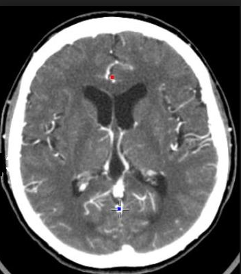 SPECT和PET和CT有什么区别，相比其他两者，SPECT有什么优势？ - 知乎