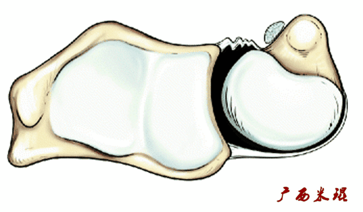 三角纤维软骨（tfcc）损伤，该如何治疗和康复呢？ - 知乎