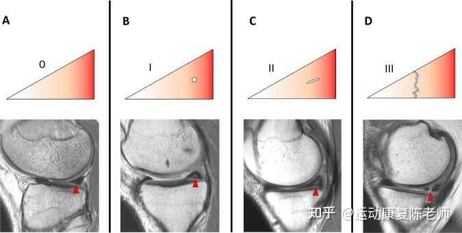 左侧膝关节外侧半月板撕裂需要手术吗？ - 知乎