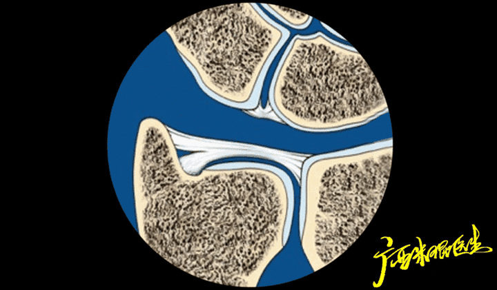 三角纤维软骨（tfcc）损伤，该如何治疗和康复呢？ - 知乎