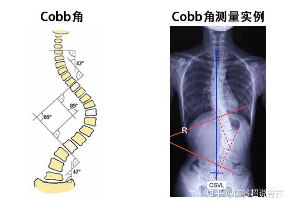 cobb角临床的意义是什么？ - 知乎