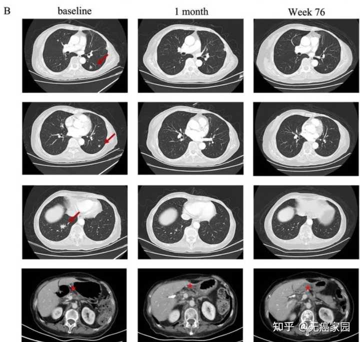 国产研发的CAR-T疗法CT041目前的研究进展如何？疗效如何？ - 知乎