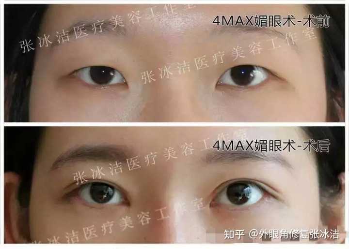 吊眼怎么整，我的眼还有救吗? - 知乎