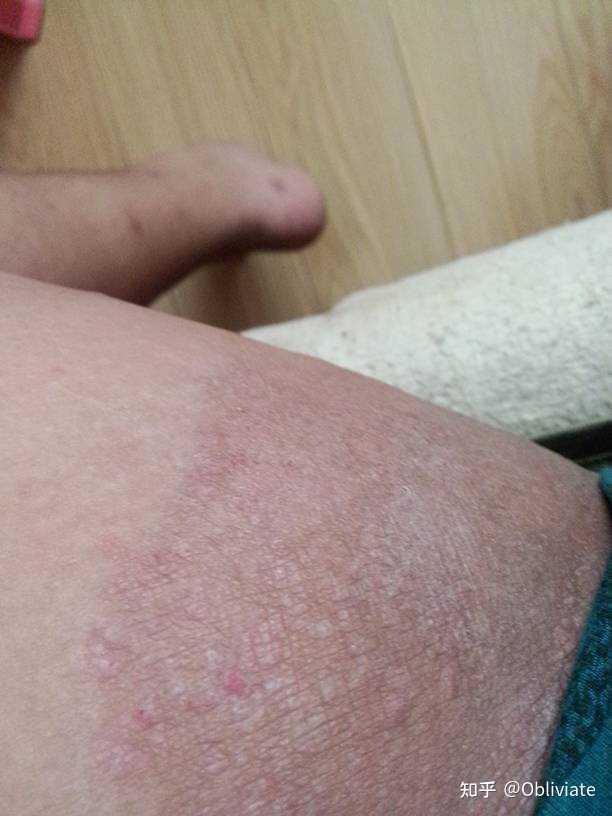 男人裆部两侧瘙痒是什么病 知乎