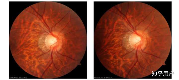 眼轴大于26mm长吗？ - 知乎