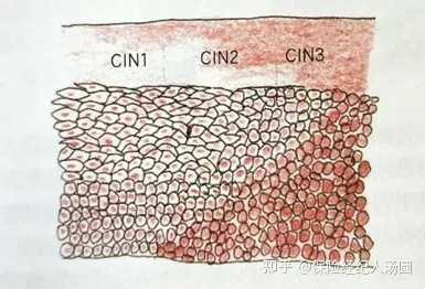 cin1加hpv感染，不治疗一定会变癌吗？ - 知乎