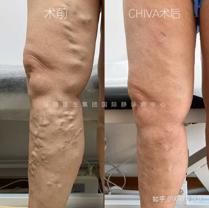 国内下肢静脉曲张CHIVA手术治疗方法成熟吗？ - 知乎