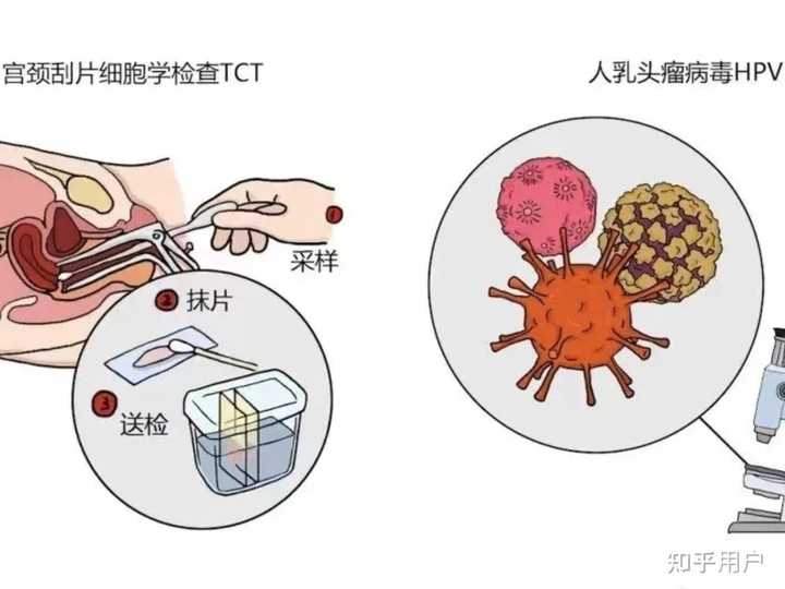 TCT和HPV检查都是什么，有什么区别呢？ - 知乎