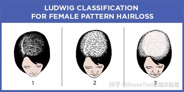 中年女性掉头发非常严重怎么办？ - 知乎