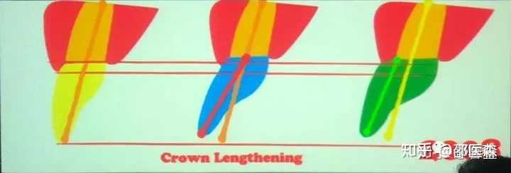 除了北京和上海，还有哪些地方有医生能做bopt（生物导向牙体预备）？ - 知乎