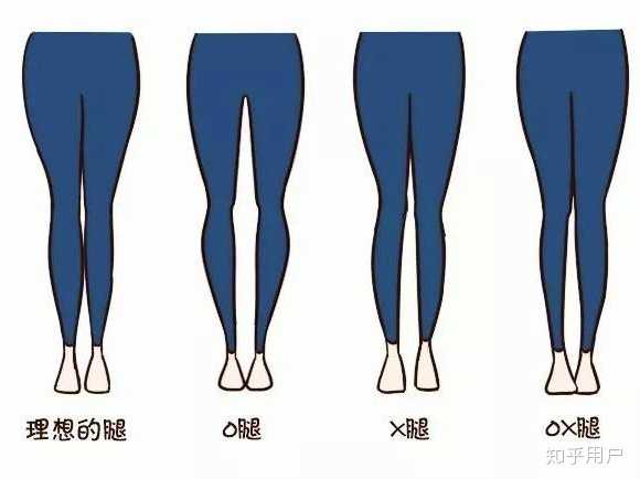 求拯救xo型腿！如何矫正？ - 知乎