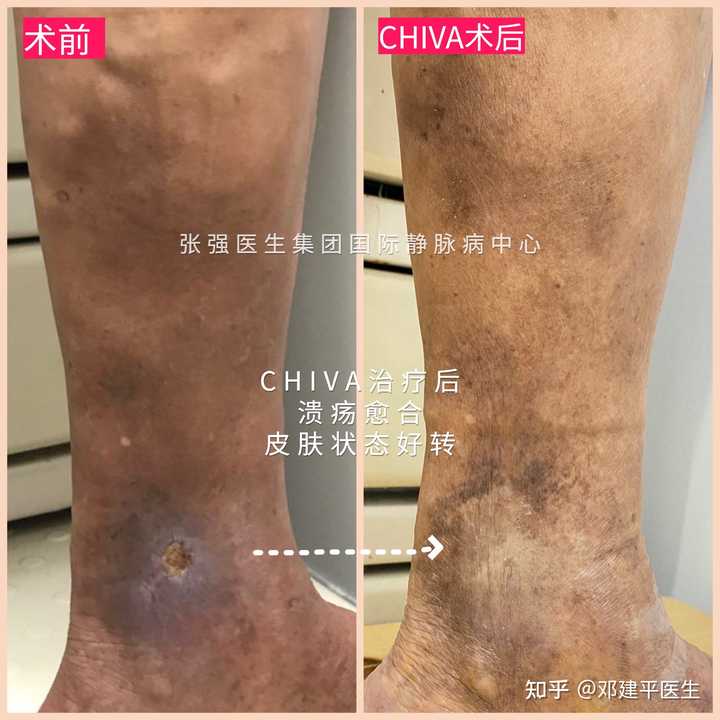 国内下肢静脉曲张CHIVA手术治疗方法成熟吗？ - 知乎