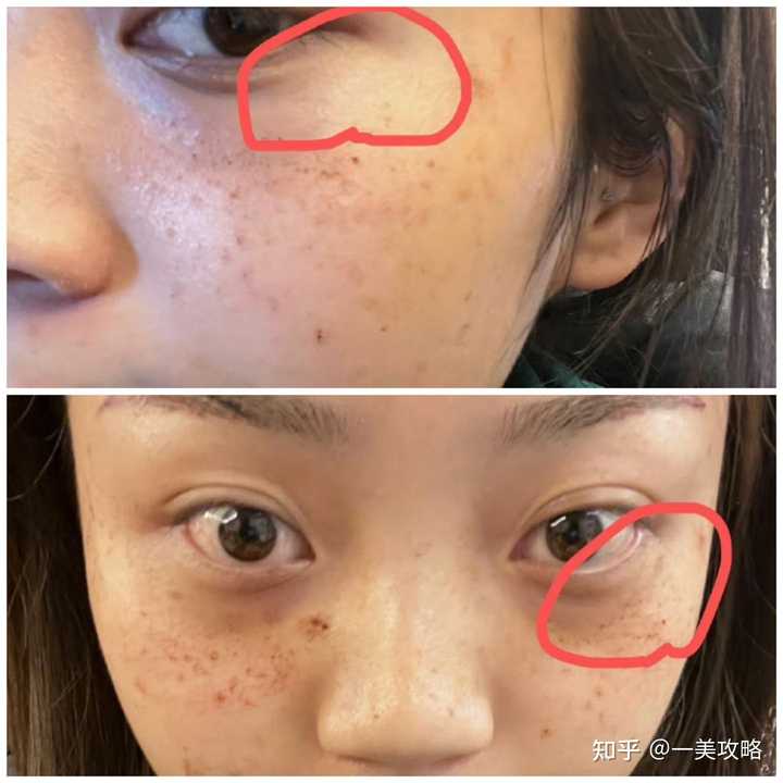 超光子和光子嫩肤有区别吗？ 知乎