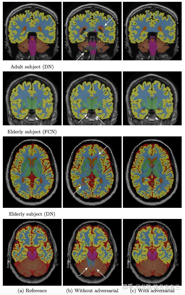 GAN网络在医学图像分割中的应用有哪些？ - 知乎