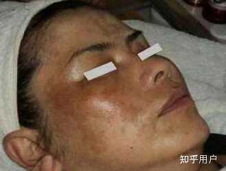 治疗黄褐斑用氢醌乳膏副作用大么? - 知乎