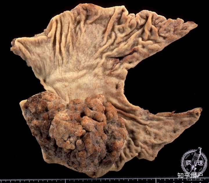 按照AJCC胃癌分期标准，这个病理报告应该怎么分期，后续化疗用药搭配有什么建议方案？ - 知乎