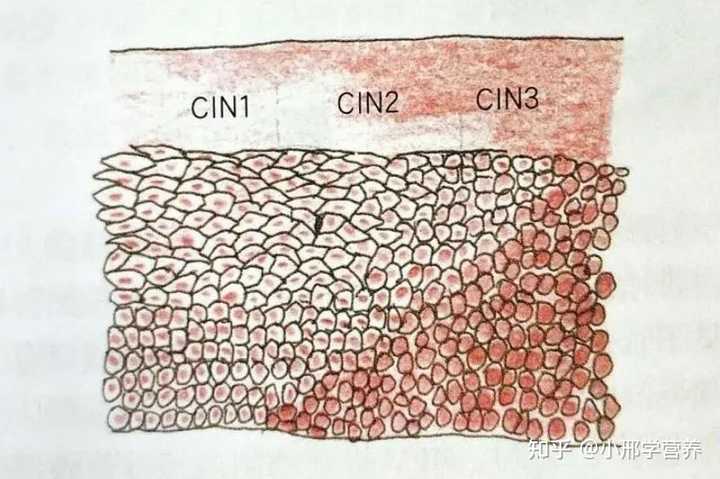 感染HPV多久会发展成cin1? - 知乎