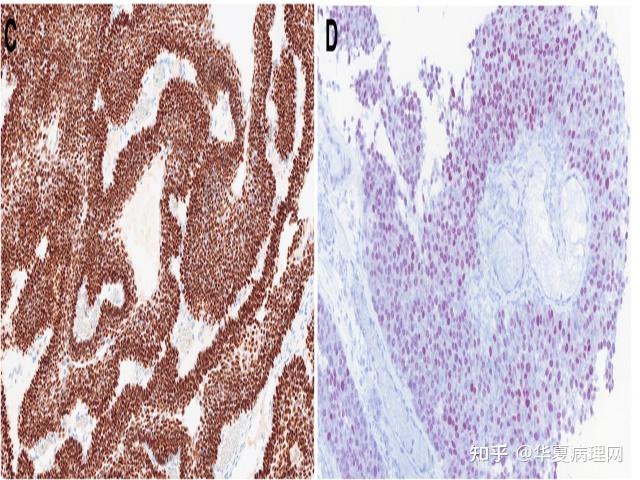 分子定义的鼻腔鼻窦恶性肿瘤-上皮部分简明版（一） - 知乎