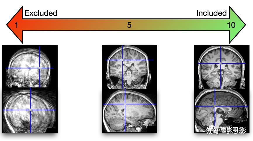 结构MRI质量的差异会显著影响脑部解剖学测量指标 - 知乎