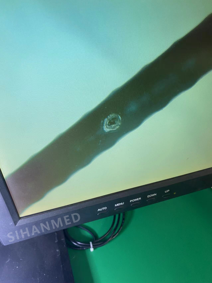 泌尿外科治疗中对于输尿管镜技术的研究及STORZ 11278VS 电子输尿管镜 维修案例 - 知乎