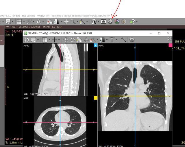 分享一个可以打开医院拷贝的原始格式(DICOM)影像资料的免费软件 - 知乎