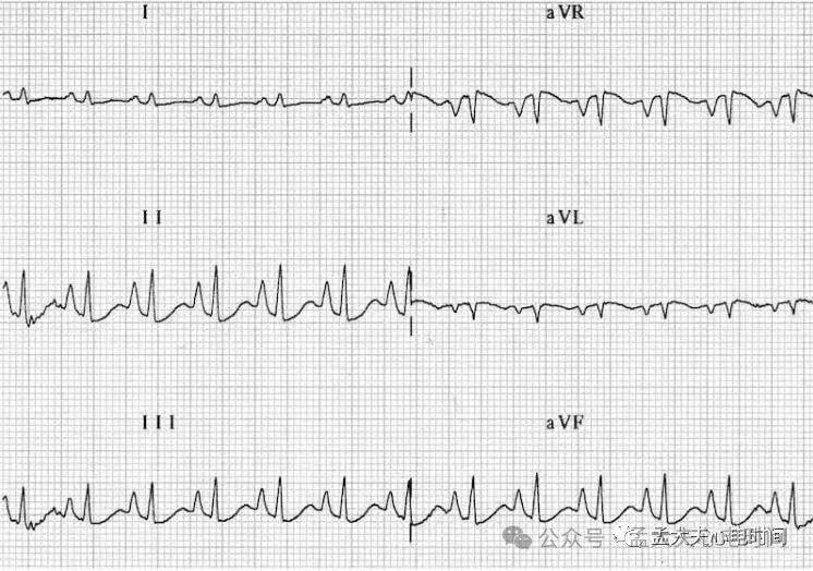 一文全解析--P波的心电图特征与临床意义 - 知乎