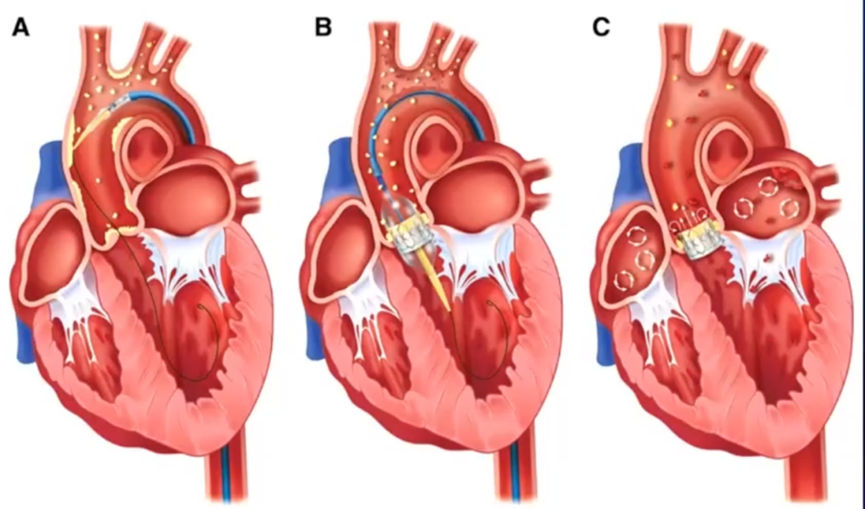 脑保护装置，为TAVR保驾护航 - 知乎