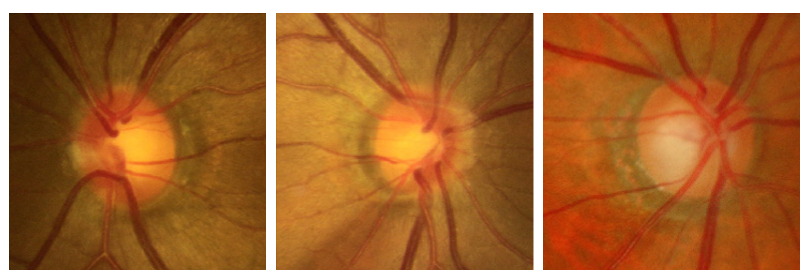Harvard Glaucoma Detection and Progression 青光眼严重程度分类数据集介绍 - 知乎