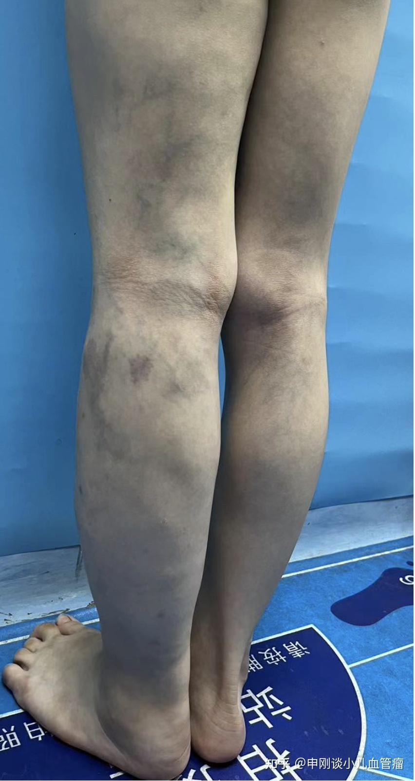 KT综合征(Klippel-Trenaunay syndrome，KTS) 介入治疗 - 知乎