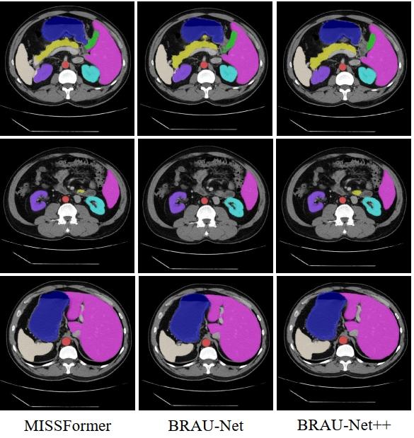 BRAU-Net++：医学图像分割的U形混合 CNN-Transformer 网络 - 知乎