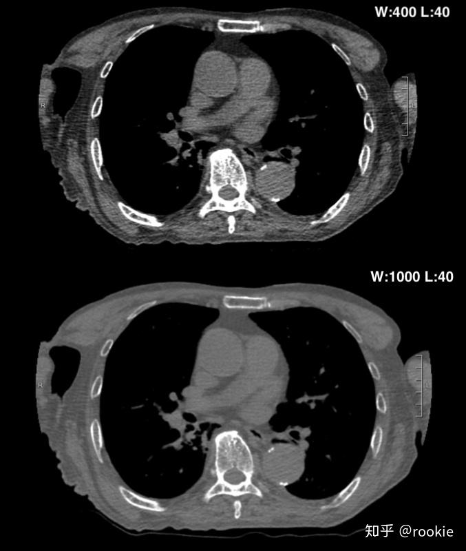 图像识别 | 计算机断层扫描基础：加窗 - 知乎