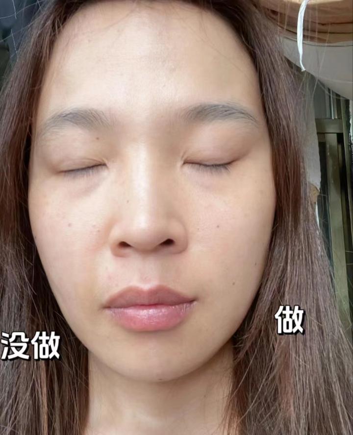这些人打完超声炮脸必凹,你真的适合打超声炮吗 知乎