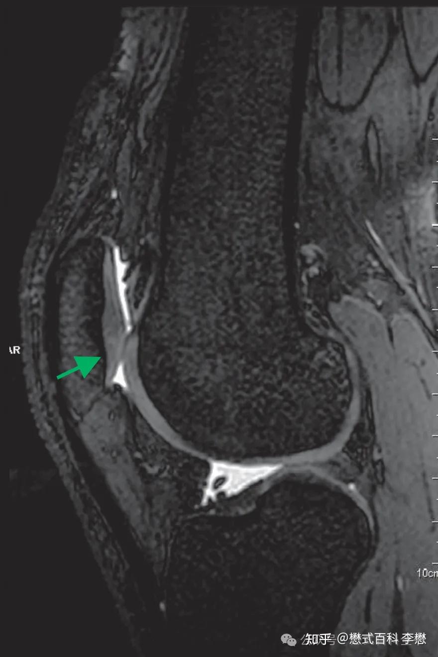 DESS序列原理及临床应用 - 知乎