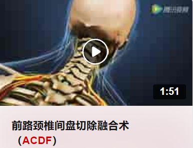 颈前路椎间盘切除融合术(ACDF) - 知乎