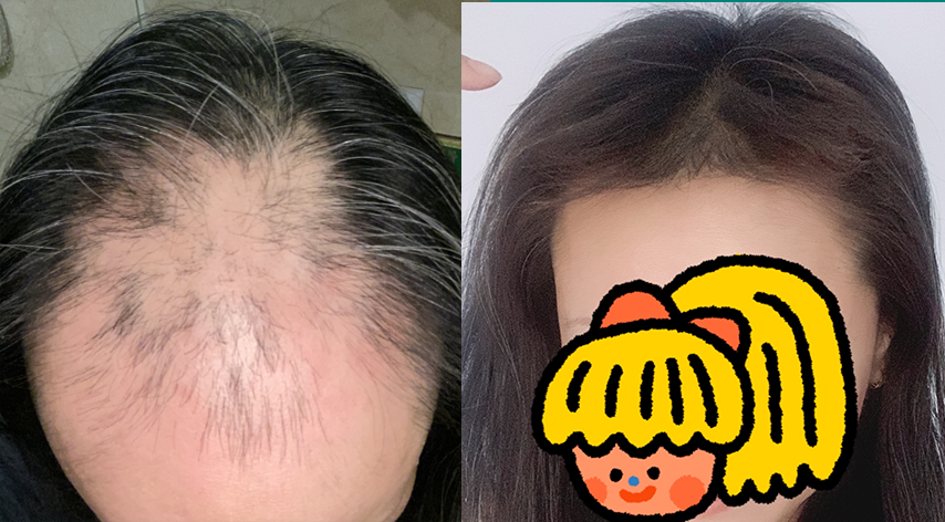 女性脱发治疗? - 知乎