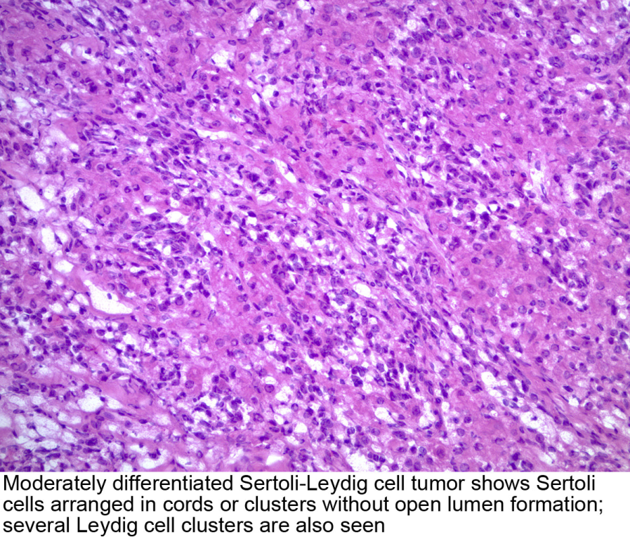 卵巢支持-间质细胞瘤（Sertoli-Leydig Cell Tumors）全面解析 - 知乎