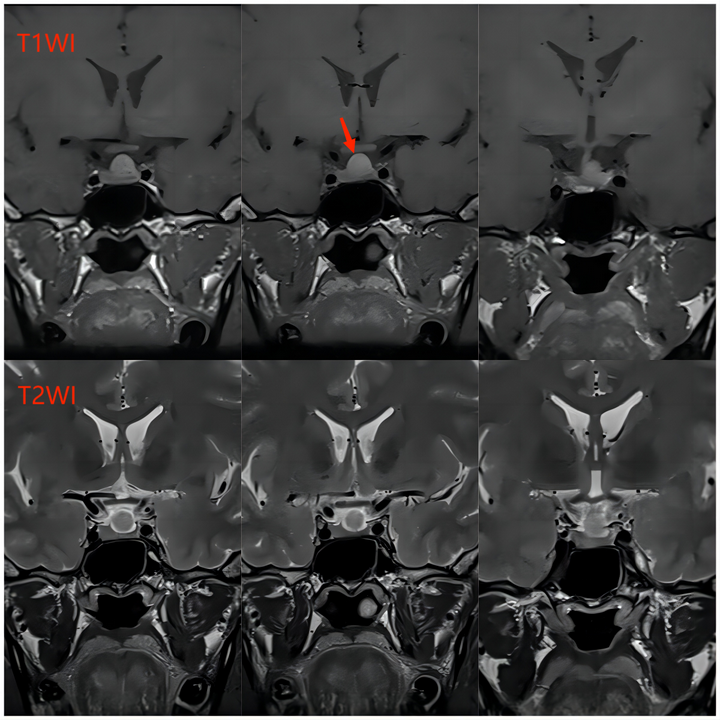 高尚病例科普：垂体Rathke囊肿 - 知乎
