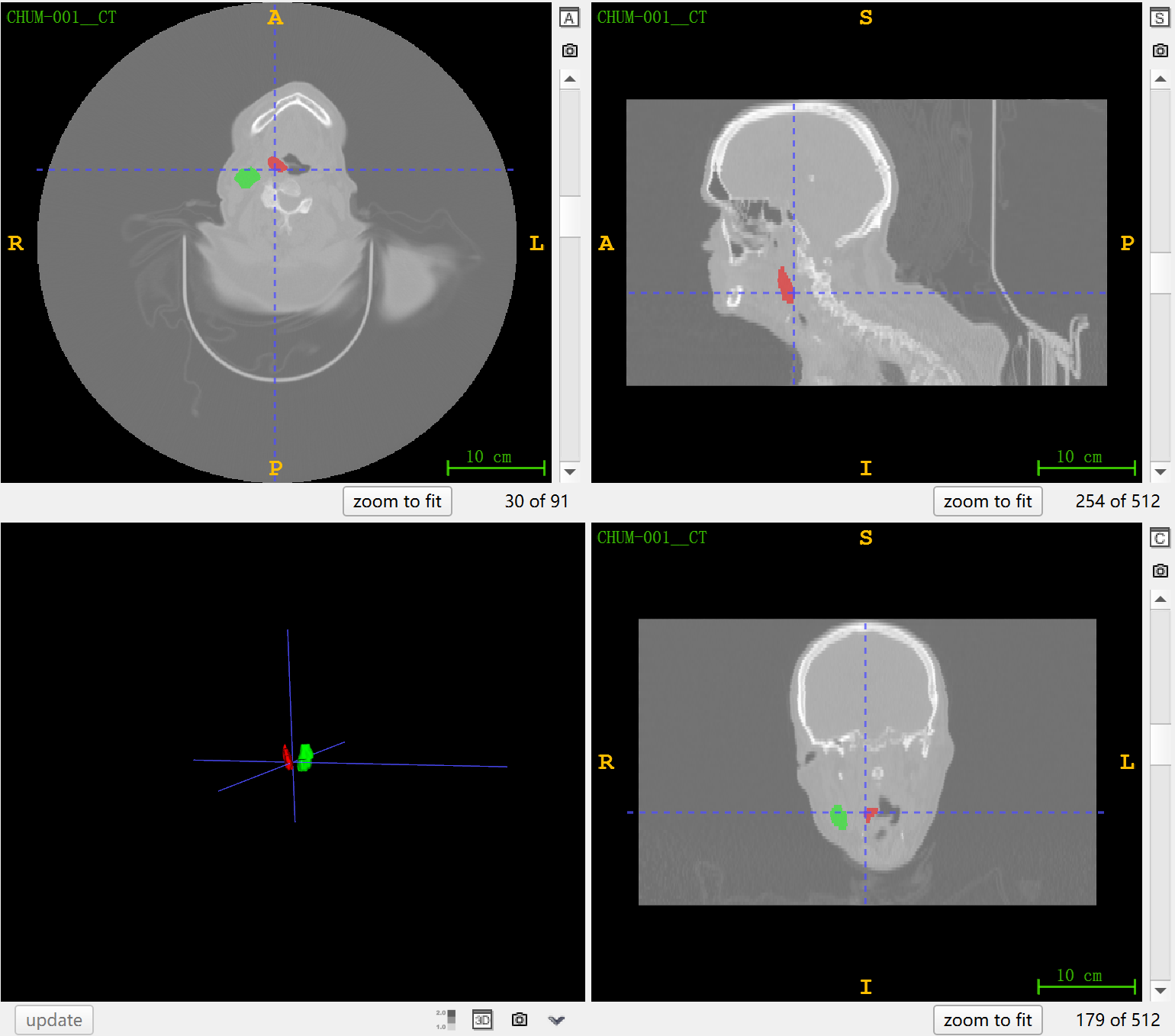 HECKTOR 2022 数据集介绍 - 知乎