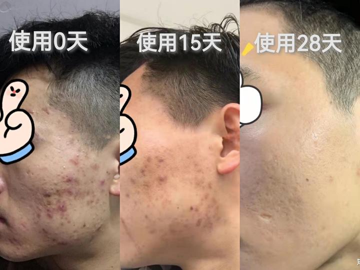 如果你经常长痘祛不干净痘,可以来看看医学生是如何祛痘去痘印的(非盈利性回答) 知乎