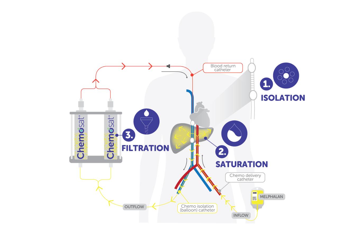 HEPZATO/CHEMOSAT(melphalan)用于经皮肝灌注中文说明书|香港济民药业 - 知乎