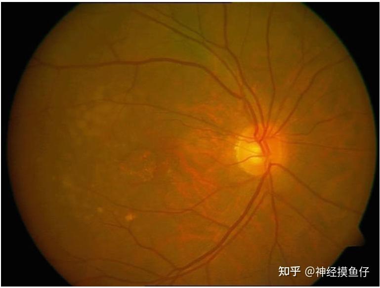 Chen et al. (2019) Retinal OCT Image Analysis 学习笔记 - 知乎