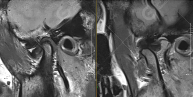 颞下颌关节紊乱的磁共振检查 - 知乎