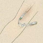 化疗 | PICC&PORT：一根通往心脏的管子 - 知乎