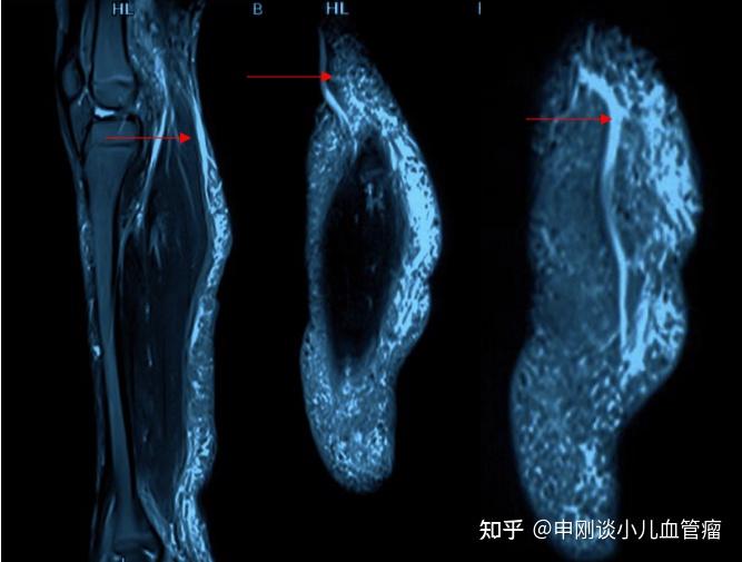 KT综合征(Klippel-Trenaunay syndrome，KTS) 介入治疗 - 知乎