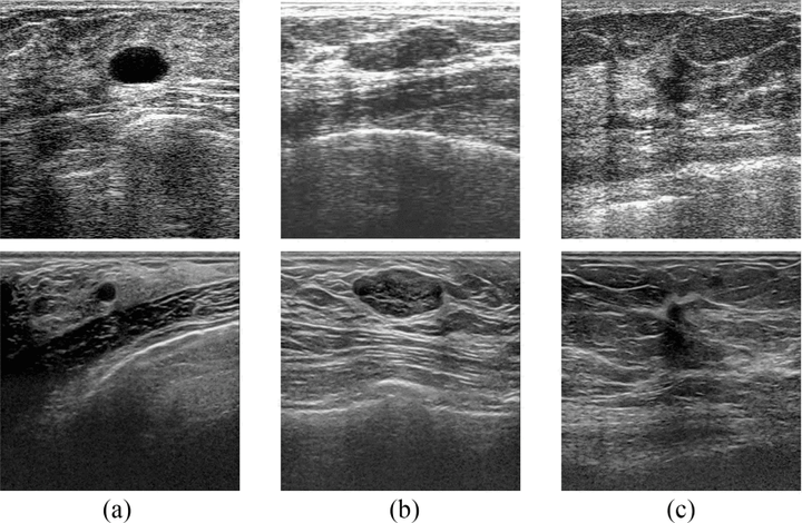 Breast Ultrasound Dataset B 数据集介绍 - 知乎