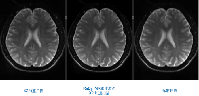 脑出血——突如其来的危机 - 知乎