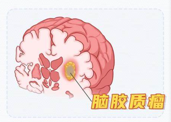 一文全览 | 【脑胶质瘤】靶向IDH1/2、BRAF/MEK、NTRK 融合、MET、FGFR、PDGFRA及抗血管生成药物 - 知乎