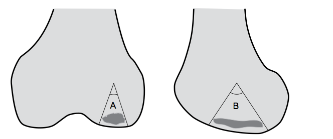 SONK（Spontaneous osteonecrosis of the knee）的诊断及治疗概述 - 知乎