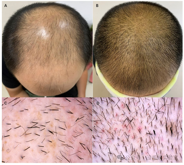 美国皮肤病学会JAAD：PRP+微针+米诺地尔攻克重度难治性脱发！ - 知乎