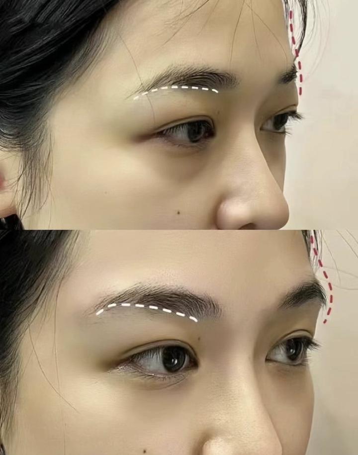眉弓做了有什么变化?什么人适合做眉弓?一般选什么材料合适?如何找到靠谱的眉弓医生?【一文读懂眉弓整形指南】 知乎